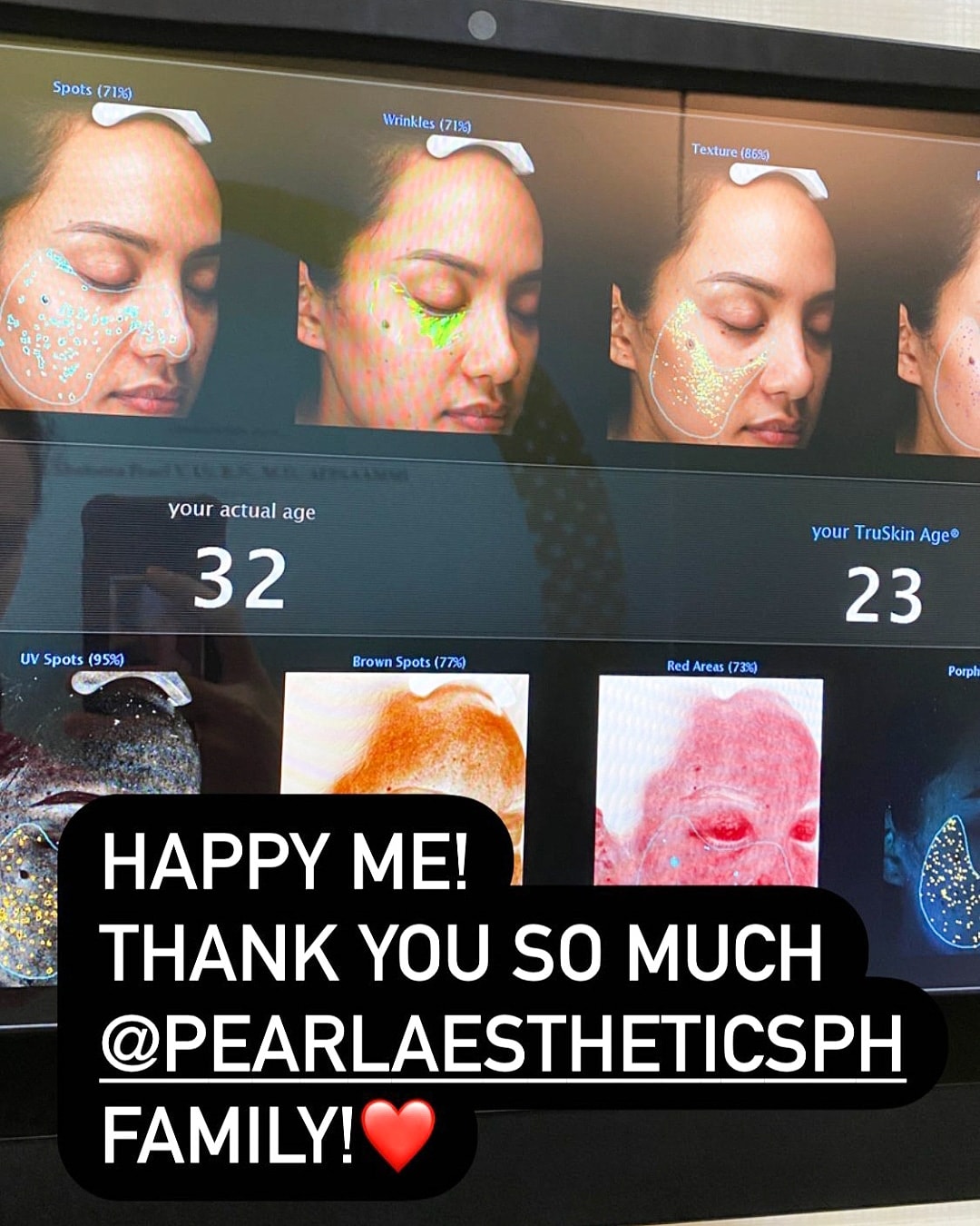 Pearl Morpheus 8 Pro Delivering The Best Of Rf Microneedling Treatment